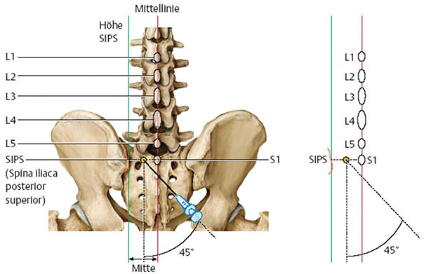 Lendenwirbelsäule - Ligamentäre Infiltration am Iliosakralgelenk (ISG ...